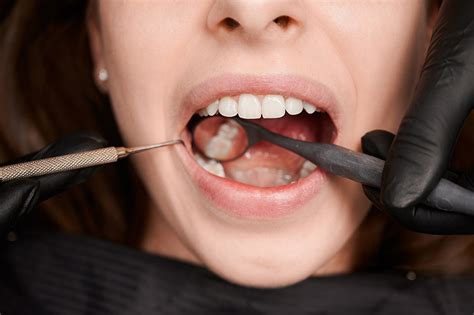 Understanding Dental Cavity Detection How Dentists Diagnose Cavities