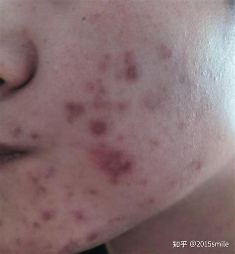 我终于找到了祛红肿痘痘的办法 知乎