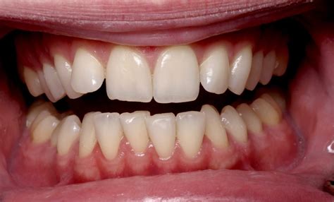 Invisalign Before And After Photos Dr Arthur Glosman