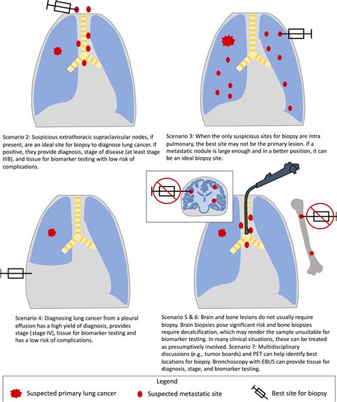 Acquiring Tissue For Advanced Lung Cancer Diagnosis And Comprehensive