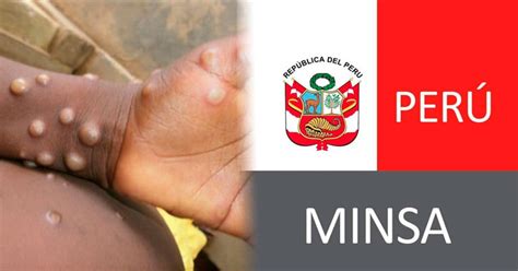 ¡alerta En Perú Minsa Declara Alerta Epidemiológica Por Introducción