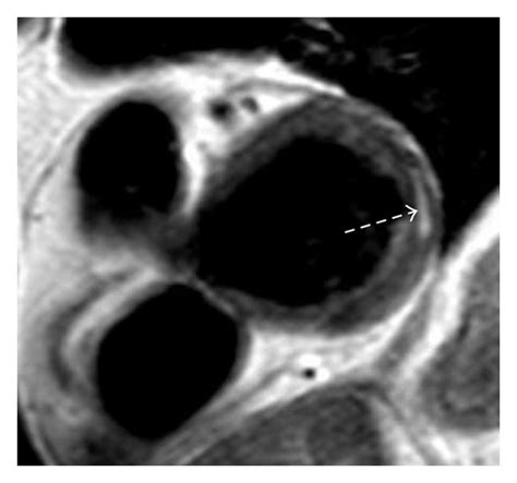 Mr Imaging In A Patient With An Acute Myocardial Infarction Upper Row
