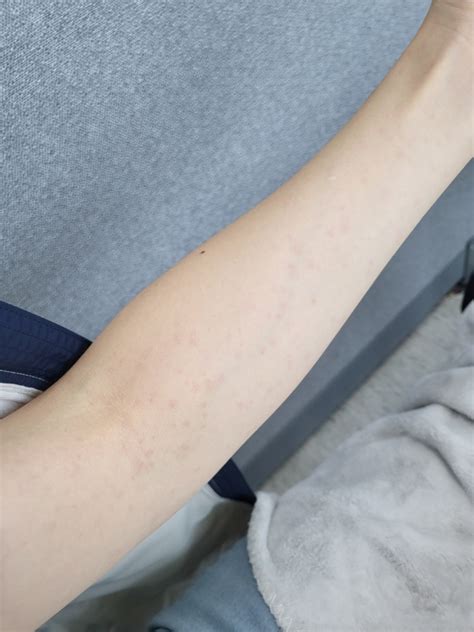 전신 발진 두드러기 이 났는데 종류가 뭔지 궁금합니다 지식in
