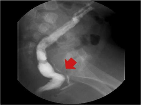 Distal Cologram Complex Rectovaginal Fistula Download Scientific