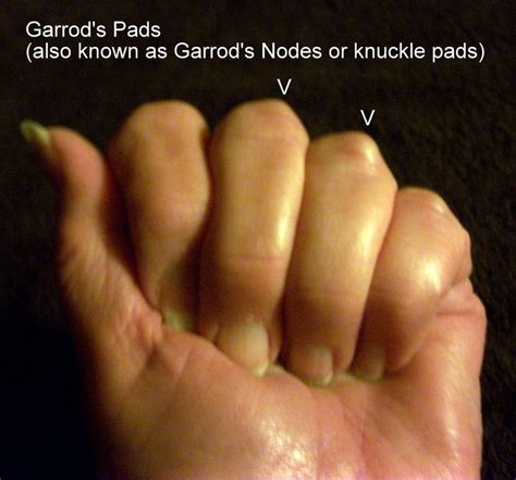 Garrods Pads Are Sometimes Seen In Those Who Have Dupuytrens