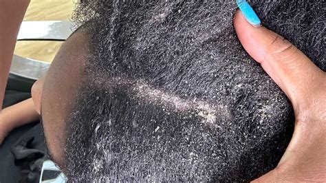 Asmr Dandruff Scratch And Result Youtube