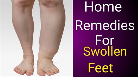 Home Remedies For Swollen Feet Reduce Feet And Ankle Swelling Youtube
