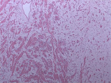 Microscopic Appearance Of The Presacral Mass Showing A Haphazard