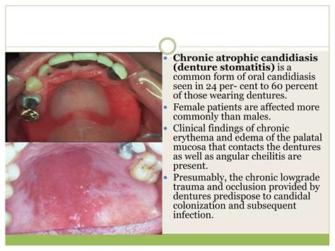 Candidiasis Pptx Candidiasis Pptx