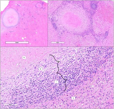 Solitary Necrotic Nodule Of The Liver Imaging Features Differential Diagnosis And Management
