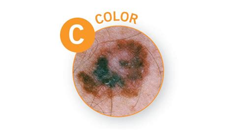 The Abcdes Of Skin Cancer Fox News