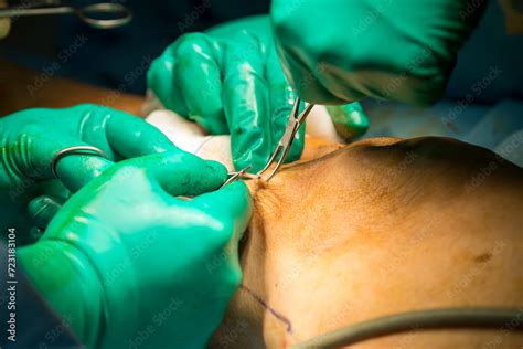 Process Of Varicose Vein Surgery In Hospital Vein Sealing Venous