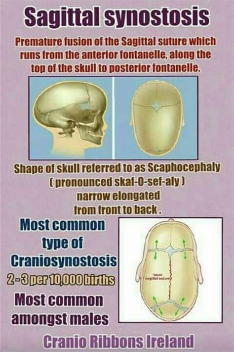 Sagittal Synostosis
