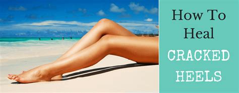 How To Heal Cracked Heels