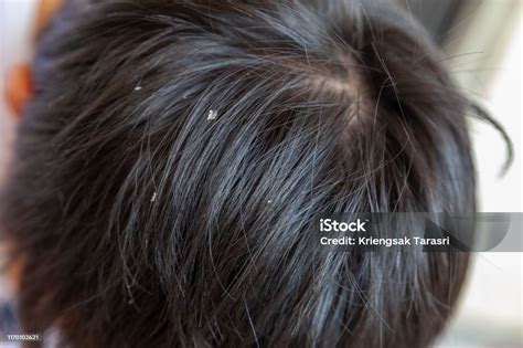 아시아 남자의 머리에 비듬 두피 건강의 개념 머리에 비듬이있는 머리카락 비듬에 대한 스톡 사진 및 기타 이미지 비듬 건조한