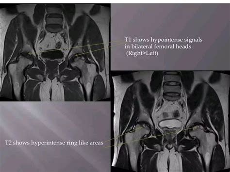 Avascular Necrosis Avn Ppt