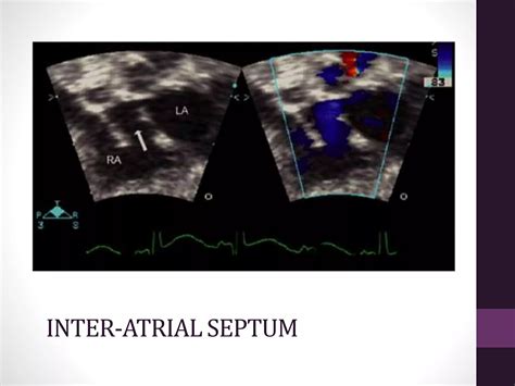 Pulmonary Atresia With Intact Interventricular Septum Pptx