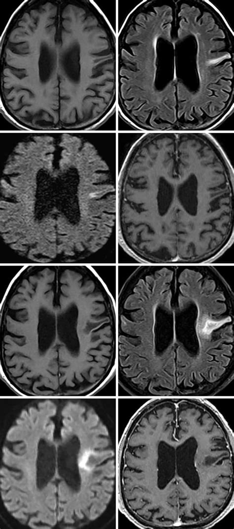 Progressive Multifocal Leukoencephalopathy Cohen Collection Volumes