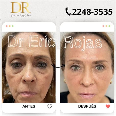 Rejuvenece tu rostro con las mejores técnicas Dr Eric Rojas