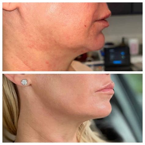 Nefertiti Lift Before And After Medspa In Florida And Georgia