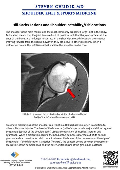 What Is A Hill Sachs Lesion At Elizabeth Simson Blog