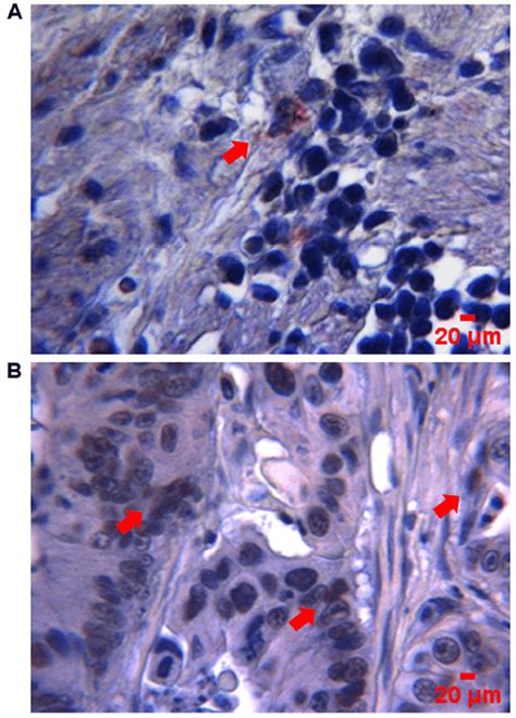 Sox9 Expression By Ihc In Cc Tumors Micrographs Showing Representative