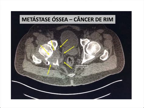 Metástase Óssea Crioablação