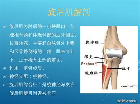 旋后肌综合征