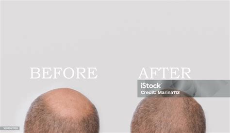 인간의 탈모 증 이나 머리카락 손실을성인 남자 손 잡고 빗 기대에 대한 스톡 사진 및 기타 이미지 기대 머리가 벗겨지는 개념 Istock