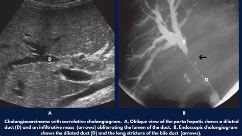 Biliary Tract Tumours Cholangiocarcinoma Cystadenoma Cystadenocarcinoma Gall Bladder Tumours
