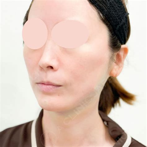 1day小顔脂肪吸引は直後から腫れにくく小顔に変身できます！処置前と施術直後の症例です40代女性 顔の脂肪吸引・糸リフト専門の美容整形