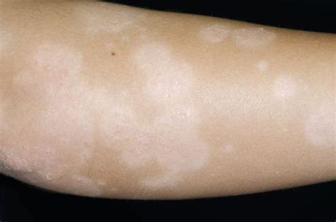 An Approach To Hypopigmentation The Bmj