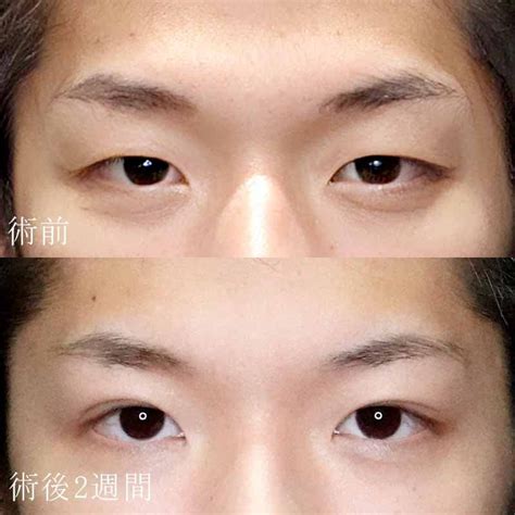 二重埋没法の症例写真 Ι 執刀医：小糸 秀 美容整形なら水の森美容クリニック