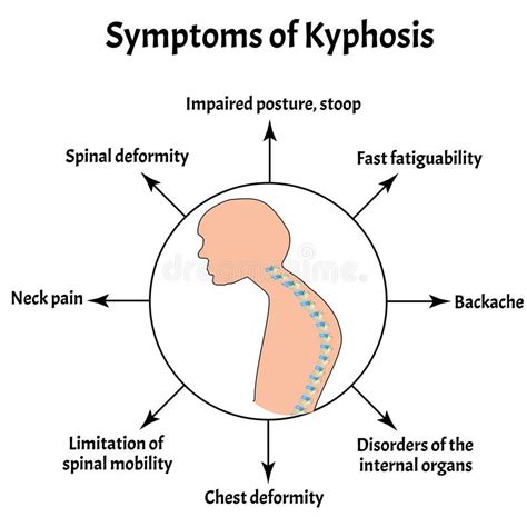 Kyphos症状 脊柱曲率，脊柱炎，劳尔多症，脊柱侧凸，关节病 姿势不当和摔倒 向量例证 插画 包括有 平面 图象 168469925