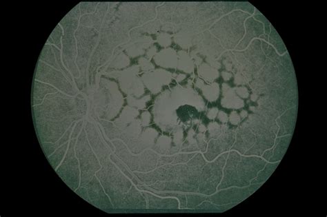 Reticular Pattern Dystrophy Retina Image Bank