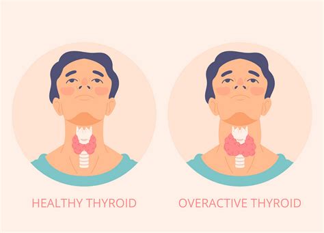 6 Types Of Thyroid Disease Symptoms Causes Treatment And Medication