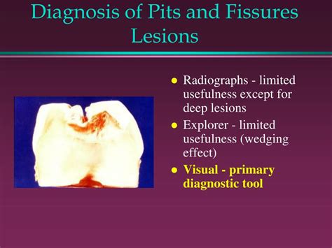 Ppt Class I And Ii Composite Restorations Principles And Techniques Powerpoint Presentation Id