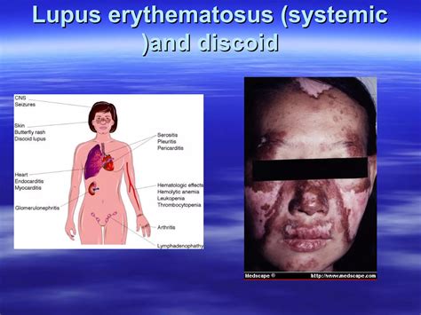 White Lesions Ppt Ppt
