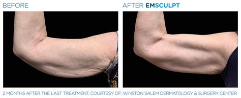 EMSCULPT Classic Chicago Body Sculpting Opulence Chicago Med Spa