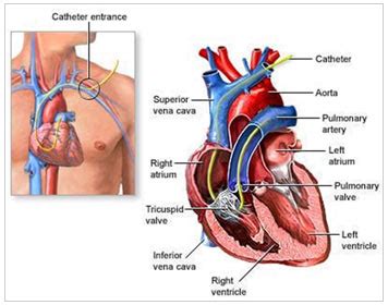 Right Heart Catheter Queensland Cardiology