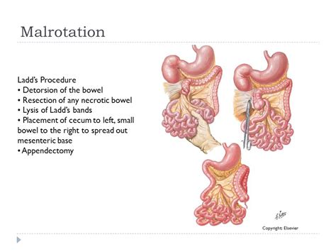 Ladds Procedure