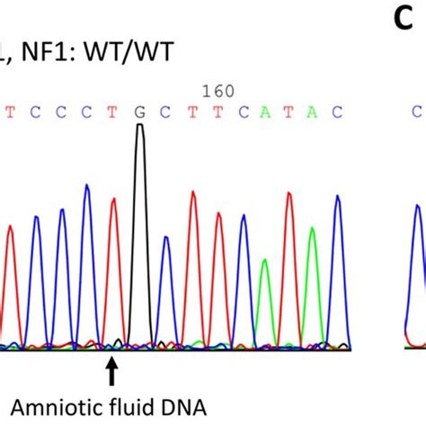Electropherogram Profile For Sanger Sequencing In The Fetus Iv 11 A Download Scientific