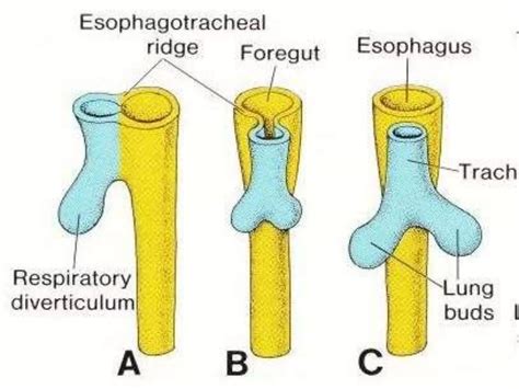 Pranaya Ppt Tracheoesopahageal Fistula Ea Tef Ppt