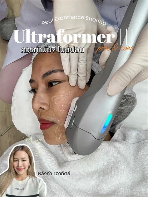 รีวิว Ultraformer Iii เหมาะกับใคร หน้าเรียวจริงมั้ย แกลเลอรีที่โพสต์
