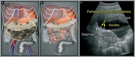 Vesicouterine Pouch Ultrasound