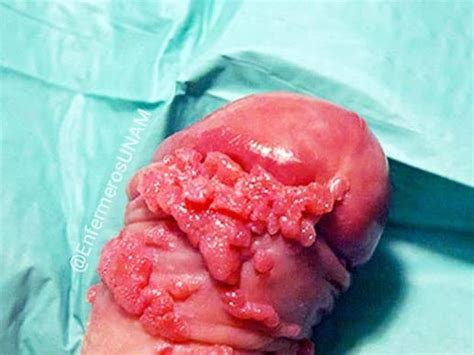 Virus Del Papiloma Humano