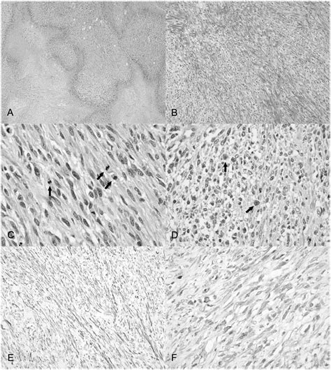 A The Tumor Shows A Fascicular Proliferative Pattern Of Download