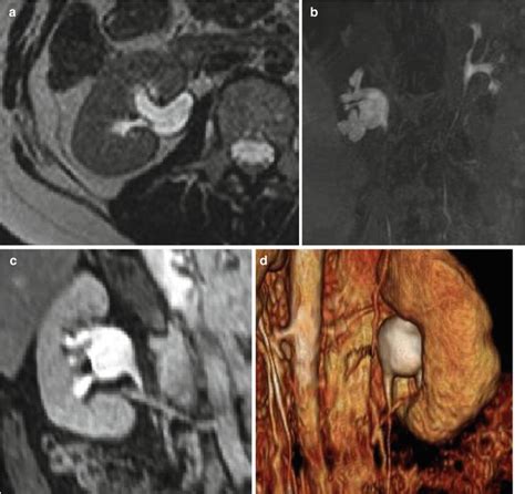 Magnetic Resonance Urography Radiology Key