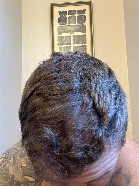 7 Months Progress Update R Hairtransplants