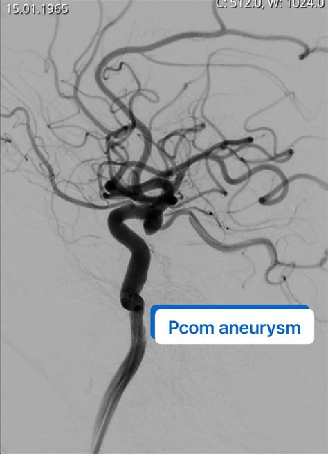 A 57 Year Old Male Patient With Pcom Aneurysm In The Supraclinoid Segment Of The Left Internal